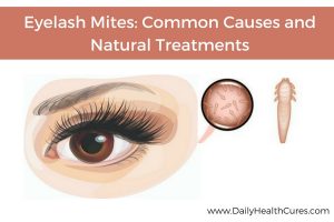 Eyelash Mites (Demodex): Common Causes, Natural Remedies