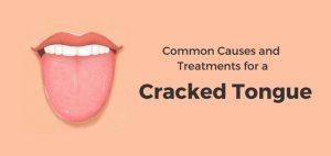 Common Causes & Treatments for Cracked Tongue | Daily Health Cures