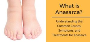 What is Anasarca? Understand the Causes, Symptoms & Treatments