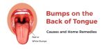 Bumps on Back of Tongue: Common Causes & Home Remedies | Daily Health Cures