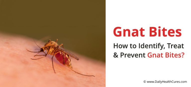 Gnat Bites: How to Identify and Treat Them? | Daily Health Cures