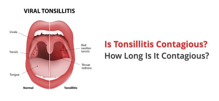 Is Tonsillitis Contagious? How Long Is It Contagious and How to Treat It?