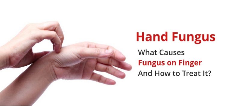 Fungus on Fingers (Hand Fungus): Causes, Symptoms, Treatments