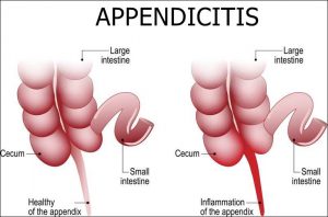 What Side is Your Appendix On? Appendicitis Symptoms, Treatments