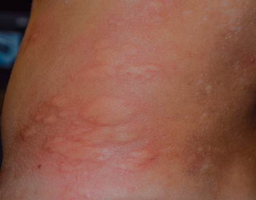Flea Bites vs. Bed Bug Bites: Different Symptoms, Treatments ...
