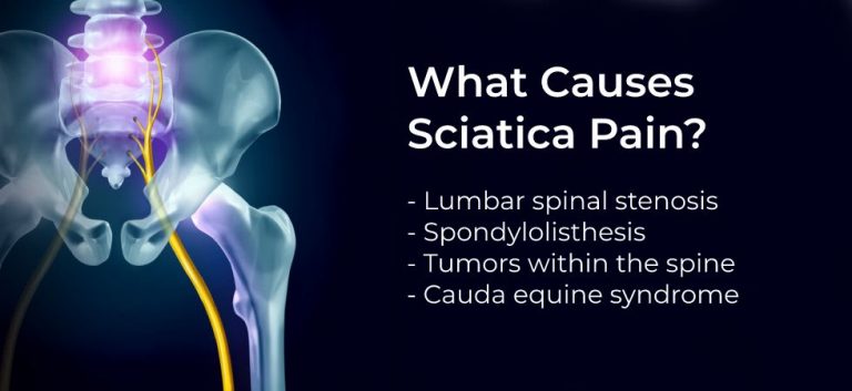 Sciatica Pain Causes, Symptoms, Treatments, and Home Remedies