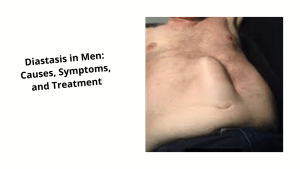 Diastasis in Men: Causes, Symptoms, and Treatment | DailyHealthCures