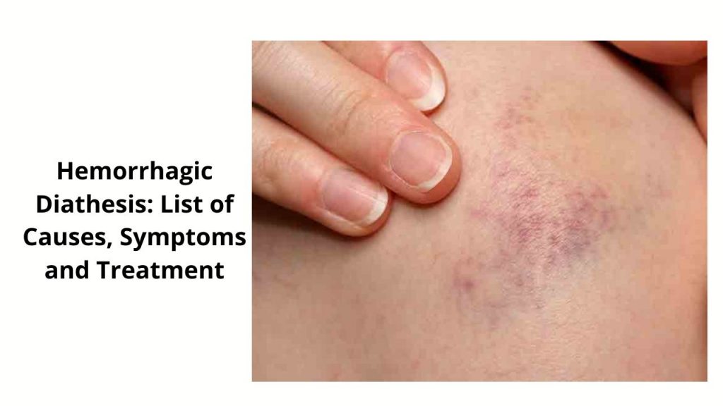 Hemorrhagic Diathesis: Causes, Symptoms and Treatment