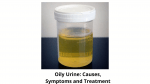 Oily Urine: Causes, Symptoms and Treatment | DailyHealthCures.com