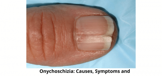 Onychoschizia: Causes, Symptoms, and Treatment