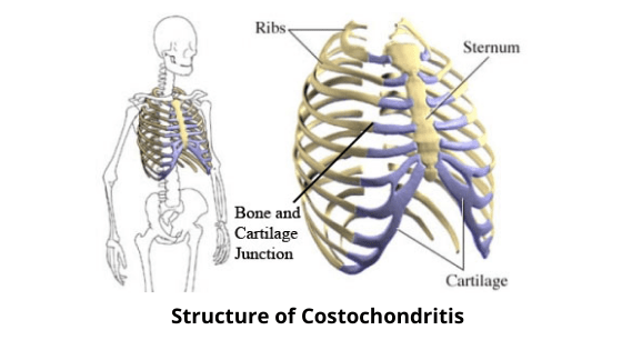 Costochondritis: List of Causes, Symptoms and Treatment
