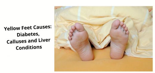 Yellow Feet Causes: Diabetes, Calluses and Liver Conditions