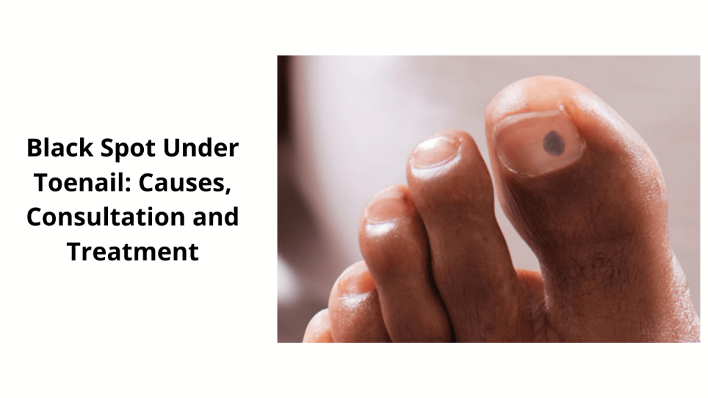 Black Spot Under Toenail: Causes, Consultation and Treatment