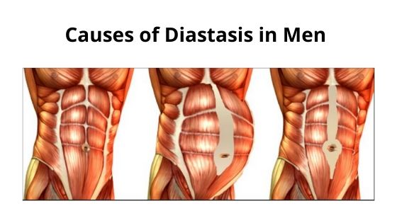 Diastasis in Men: Causes, Symptoms, and Treatment | DailyHealthCures