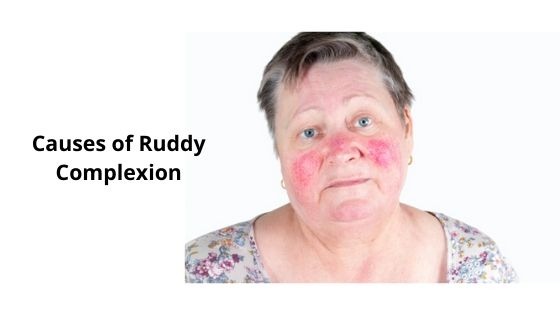 Ruddy Complexion: Causes and Remedies | Daily Health Cures