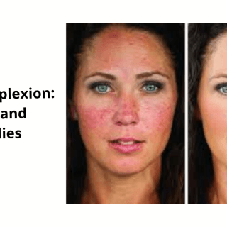 Causes of Ruddy Complexion Archives | Daily Health Cures