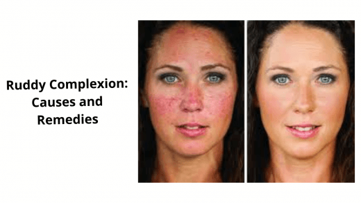 Ruddy Complexion: Causes and Remedies | Daily Health Cures