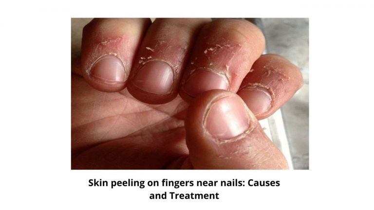 Skin peeling on fingers near nails: Causes and Treatment