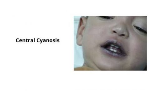 Circumoral Cyanosis: List of Causes, Risks | Daily Health Cures