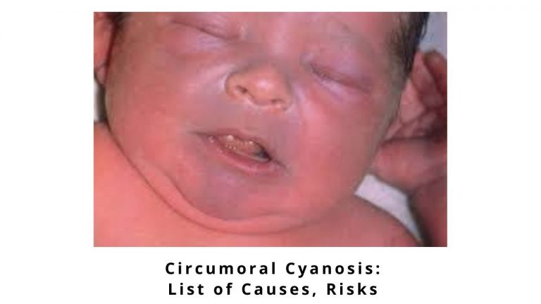Circumoral Cyanosis: List of Causes, Risks | Daily Health Cures