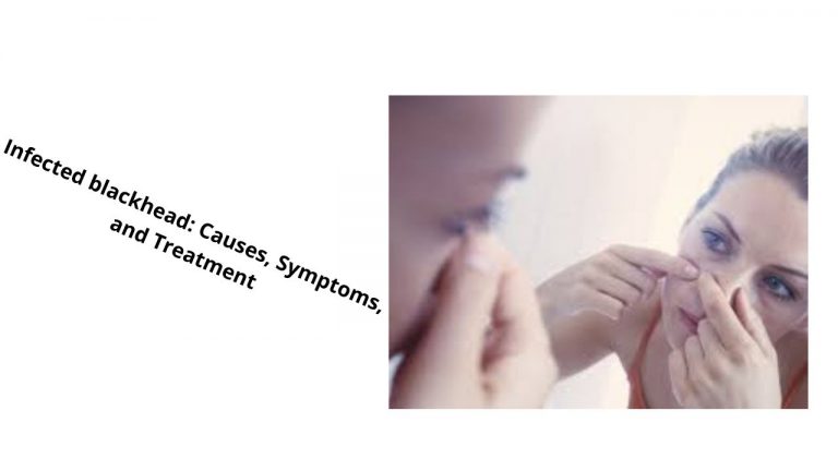 Infected blackheads: Causes, Symptoms, and Treatment